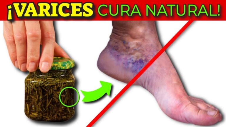 Venas Inflamadas en los Pies: Causas, Síntomas y Tratamientos Efectivos ...